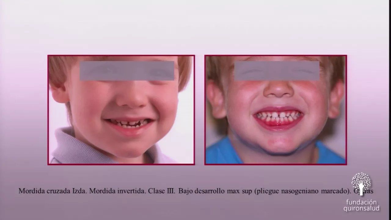 Nuevas indicaciones de la amigdalectomía parcial y total - Dr. Jordi ...